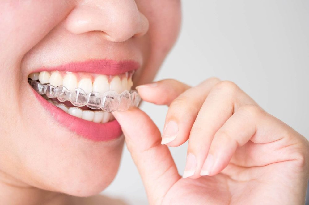 Knirschschiene gegen Zähneknirschen (Bruxismus)