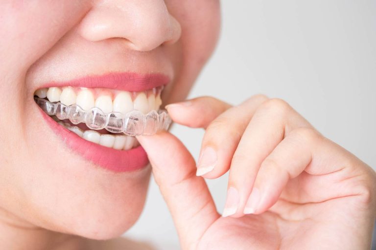 Knirschschiene gegen Zähneknirschen (Bruxismus)